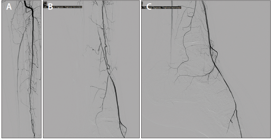 Multiple Lower Limb Occlusions and Vascular Anomaly - Endovascular Today