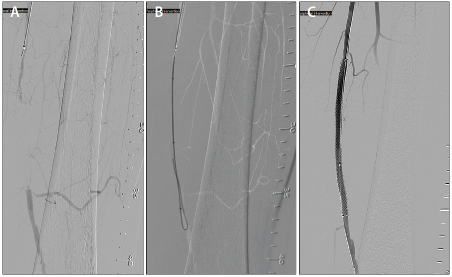 Multiple Lower Limb Occlusions and Vascular Anomaly - Endovascular Today