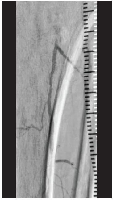 Optimizing Endovascular Treatment for Multilevel Disease in Patients ...