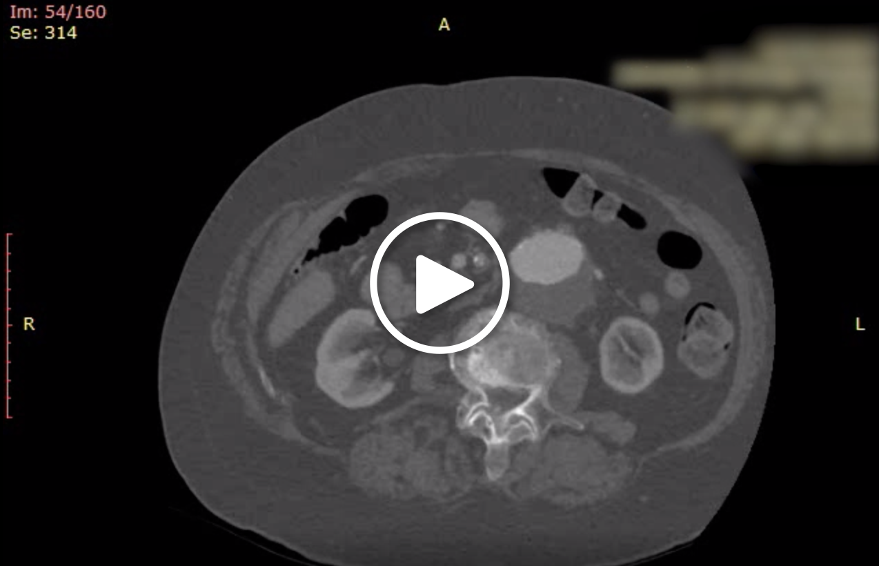 Enlarging AAA in a Patient With Multiple Comorbidities - Endovascular Today