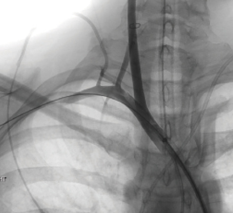 Central Line Misplacement Leading to Stroke - Endovascular Today