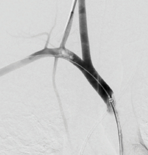 Central Line Misplacement Leading to Stroke - Endovascular Today