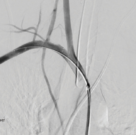 Central Line Misplacement Leading to Stroke - Endovascular Today