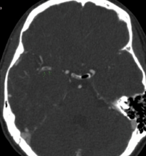 Central Line Misplacement Leading to Stroke - Endovascular Today