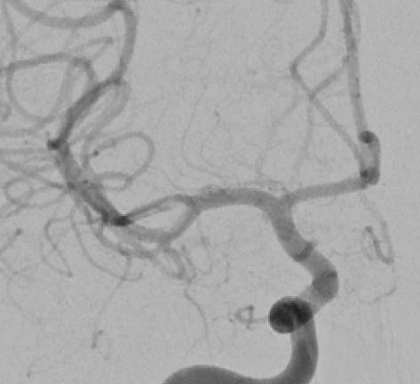 Central Line Misplacement Leading to Stroke - Endovascular Today