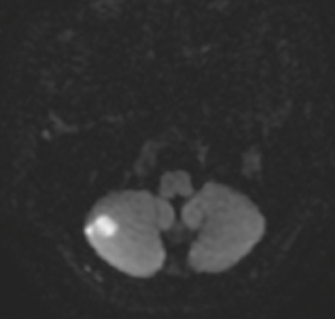 Central Line Misplacement Leading to Stroke - Endovascular Today