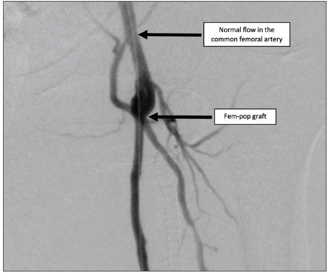 Case Report: Severe Common Femoral Artery Disease and Failed ...