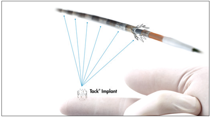 Post-PTA Dissection Repair in the Bifurcation Using the Tack ...