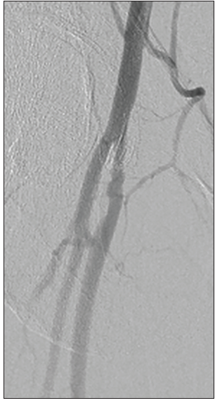 Post-PTA Dissection Repair in the Bifurcation Using the Tack ...