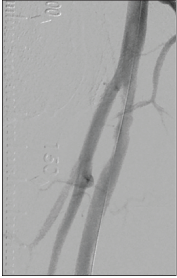 Post-PTA Dissection Repair in the Bifurcation Using the Tack ...