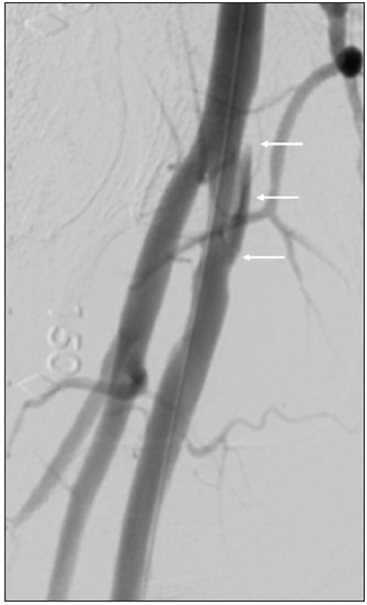 Post-PTA Dissection Repair in the Bifurcation Using the Tack ...