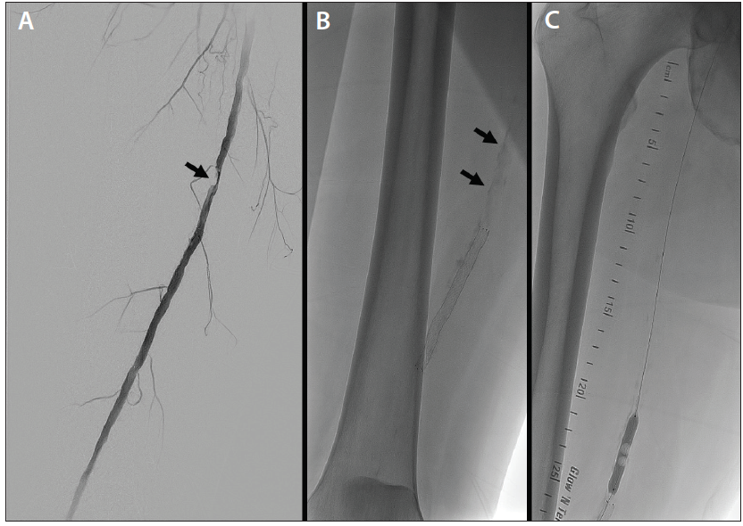 Dissection Repair After Balloon Angioplasty of a Calcified SFA Lesion ...
