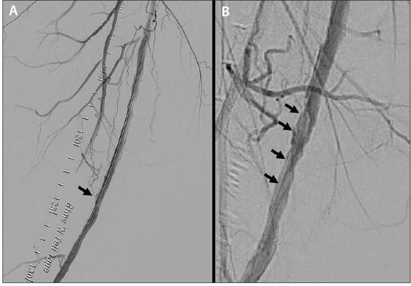 Dissection Repair After Balloon Angioplasty of a Calcified SFA Lesion ...