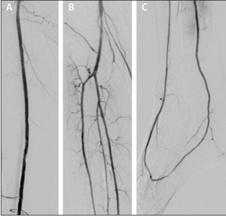 Indigo System for Peripheral Arterial Clot Management - Endovascular Today