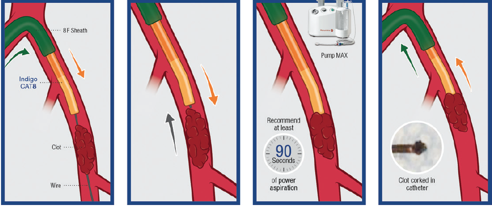 Indigo System for Peripheral Arterial Clot Management - Endovascular Today