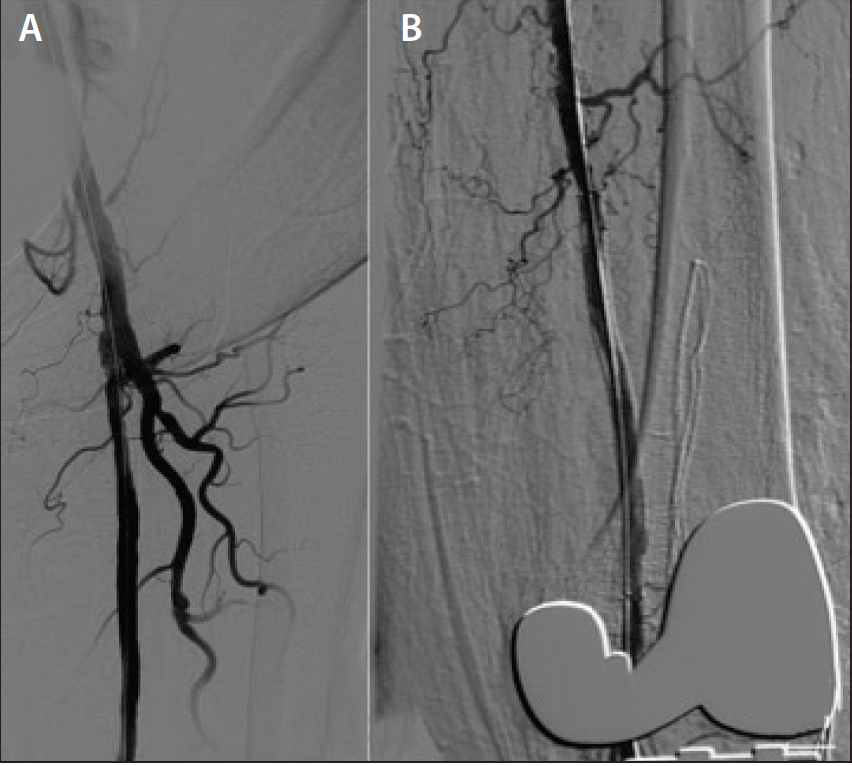 Indigo System for Peripheral Arterial Clot Management - Endovascular Today