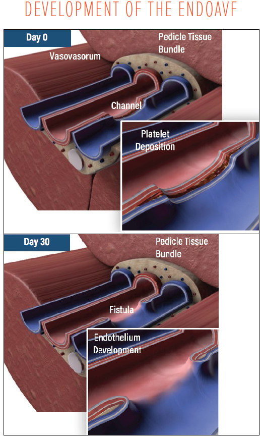 In the Spirit of Medical Innovation - Endovascular Today