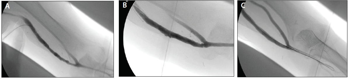 The Use of the LUTONIX® 035 Drug Coated Balloon PTA Catheter for ...