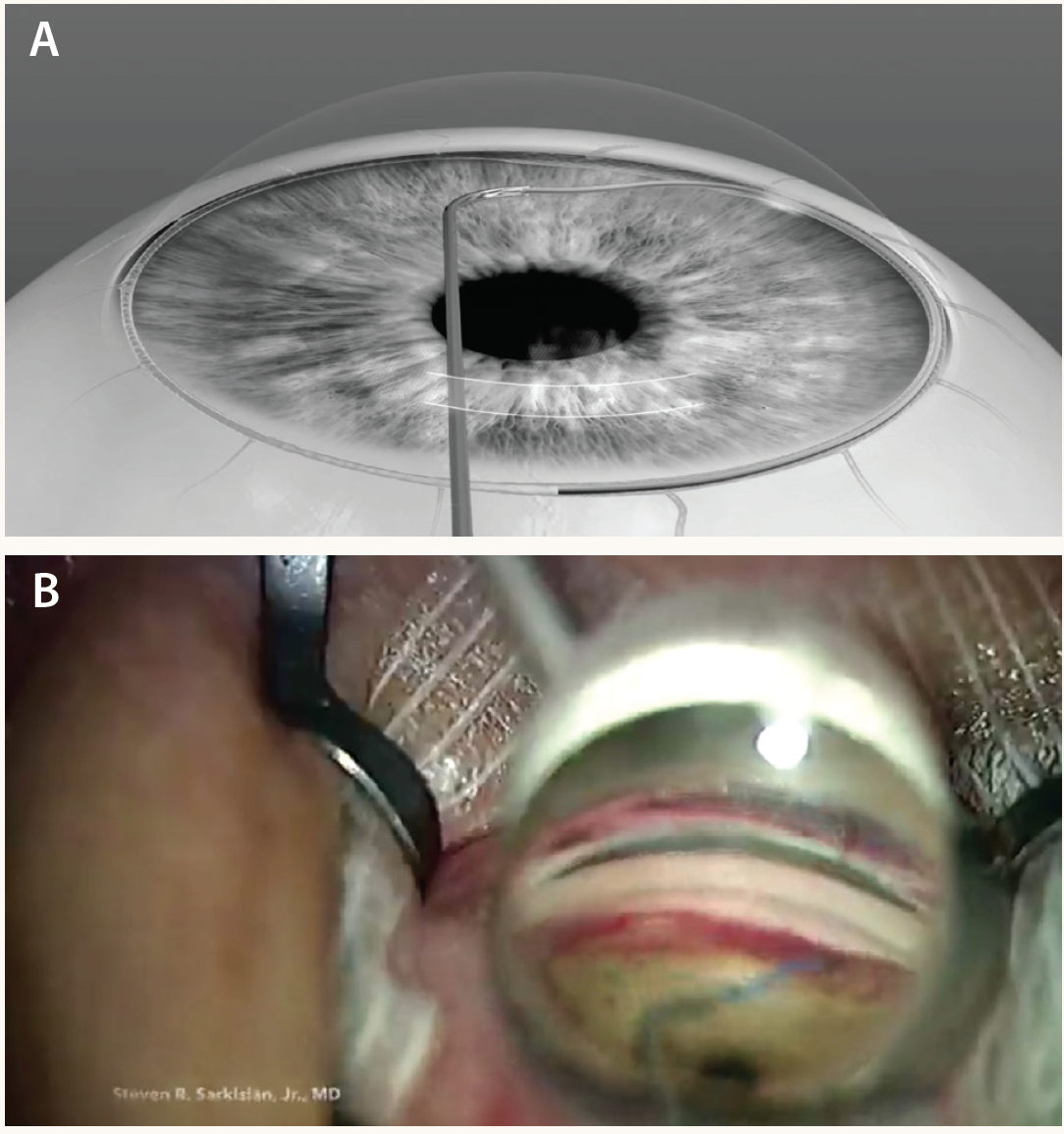 Where We Are Today With MIGS - Glaucoma Today