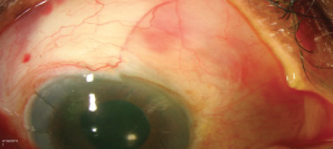 Pediatric MIGS - Glaucoma Today