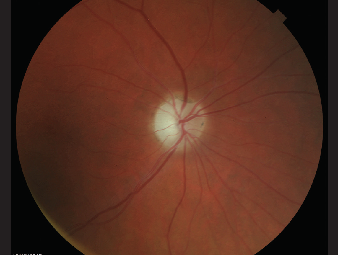 Beware the Impostor - Glaucoma Today