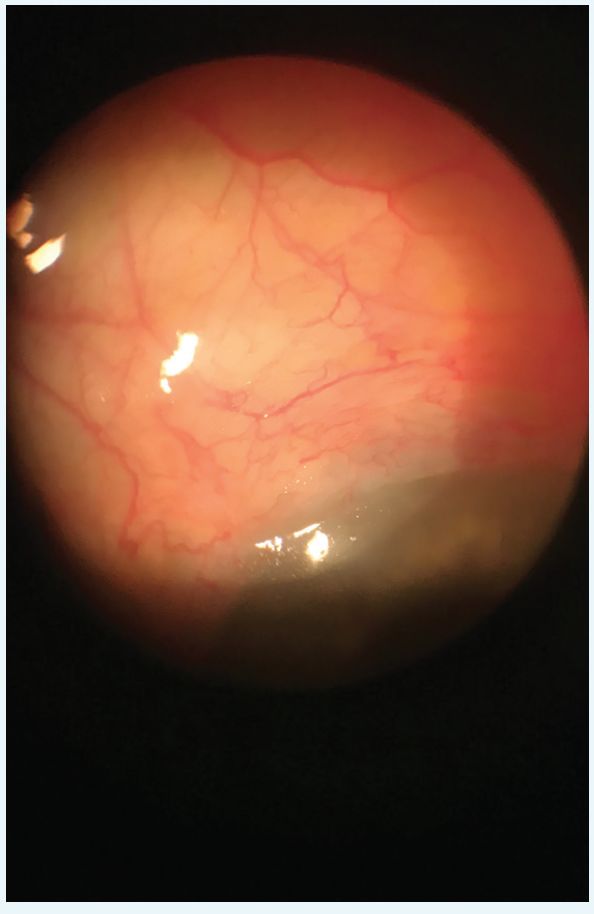 My First Subconjunctival MIGS Cases - Glaucoma Today