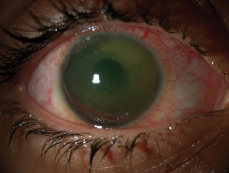 Trauma-Induced Glaucoma - Glaucoma Today