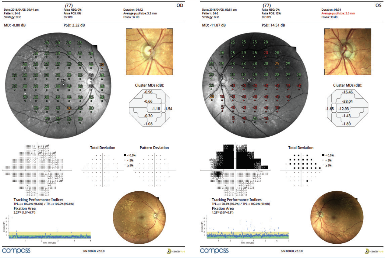 A Two-Pronged Approach - Glaucoma Today