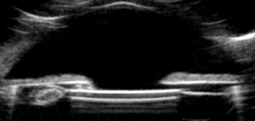 Glaucoma and Intermittent Monocular Diplopia - Glaucoma Today