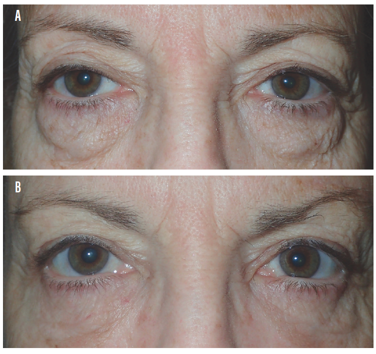 Cosmetic Surgery in the Glaucoma Patient - Glaucoma Today