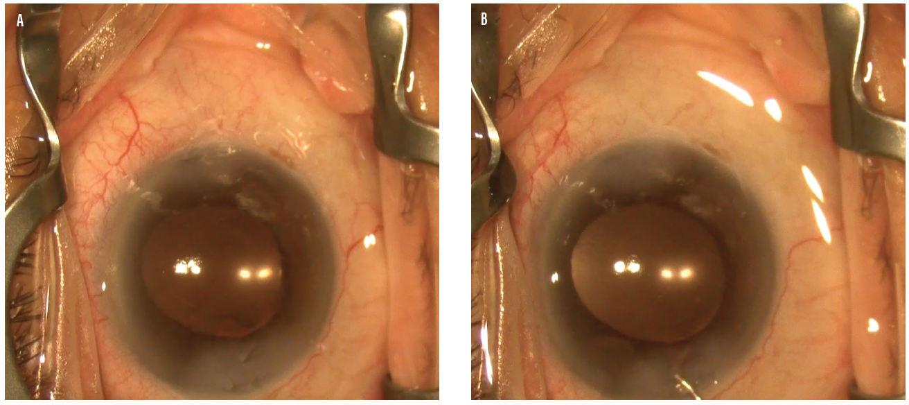 Stenting Versus Goniotomy - Glaucoma Today