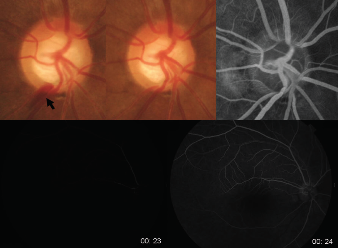 Splinter Hemorrhages Eye