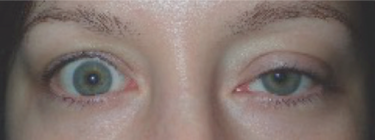 Thyroid Eye Disease - Glaucoma Today