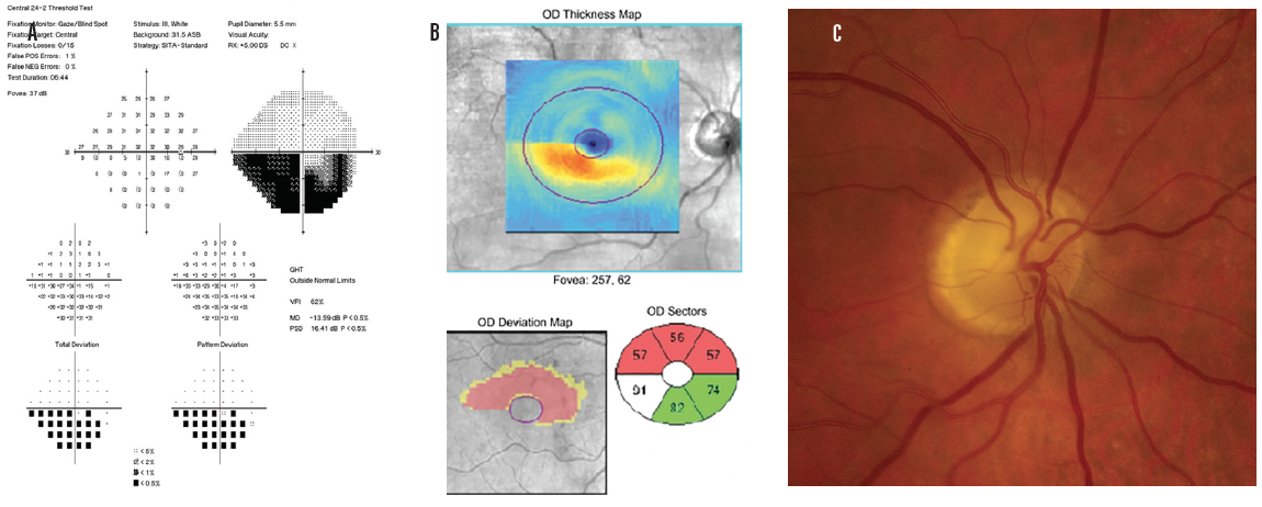 NAION: What to Do and When - Glaucoma Today