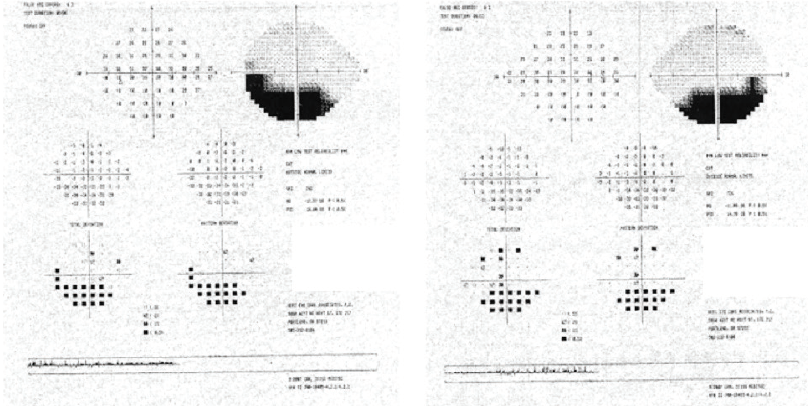 Masqueraders of Glaucoma - Glaucoma Today