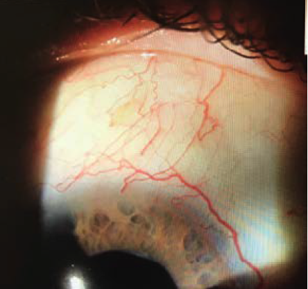 XEN Needling Case Examples - Glaucoma Today
