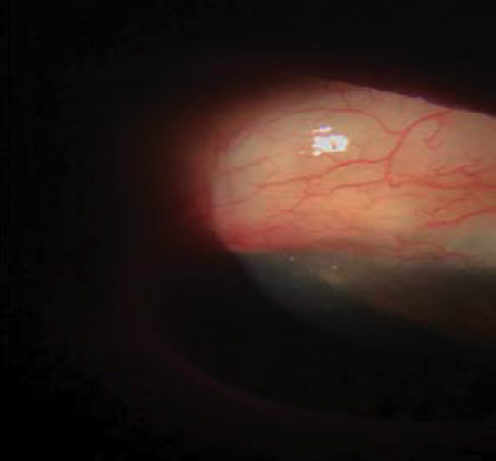 XEN Needling Case Examples - Glaucoma Today