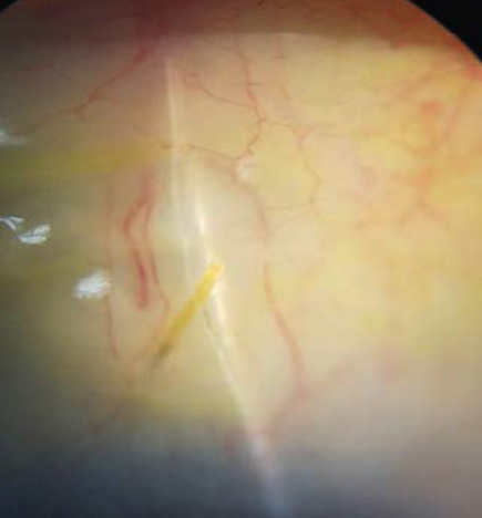 XEN Needling Case Examples - Glaucoma Today