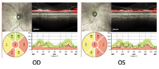 Glaucoma or Something Else? - Glaucoma Today