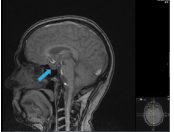 Glaucoma or Something Else? - Glaucoma Today