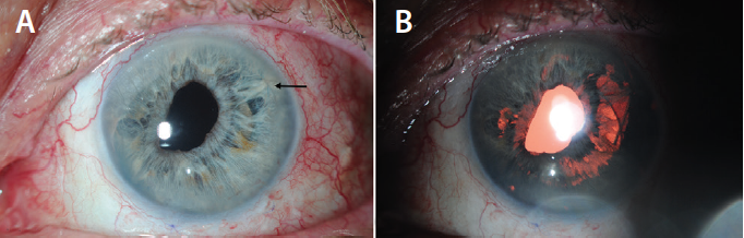Recurrent UGH Syndrome in an Eye With a Scleral-Fixated IOL - Glaucoma ...