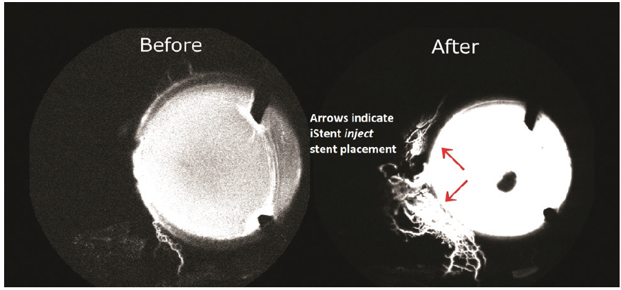 iStent inject Versus iStent: The iStent inject Advantage - Glaucoma Today