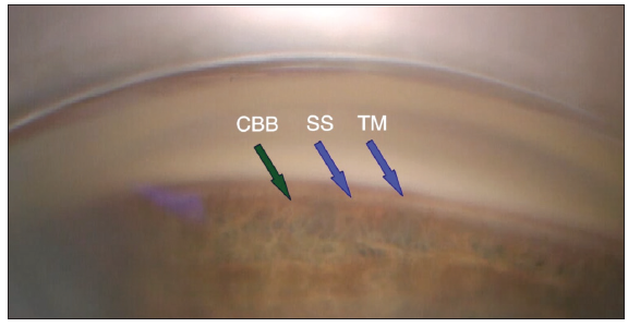 Keys to Success With the iStent inject - Glaucoma Today