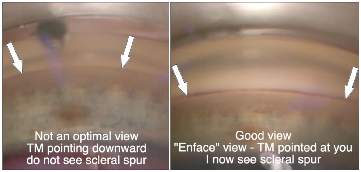 Keys to Success With the iStent inject - Glaucoma Today