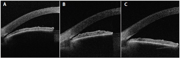 When Should I Perform Lens Extraction Alone for the Primary Angle ...