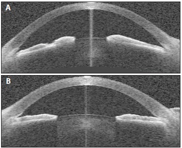 Understanding the Problem of Angle-Closure Glaucoma - Glaucoma Today
