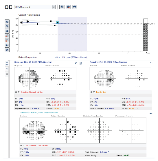 Am I Getting Worse, Doc? - Glaucoma Today