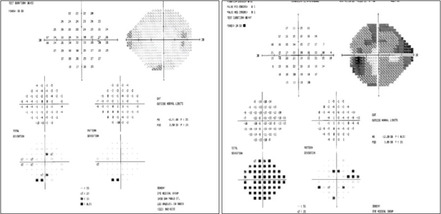 Not a Routine Case of Pigmentary Dispersion Syndrome or Uveitic ...