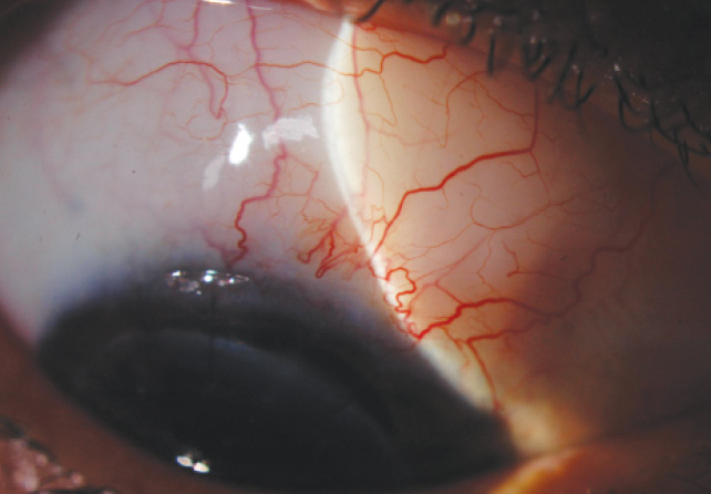 Glaucoma After Penetrating Keratoplasty - Glaucoma Today
