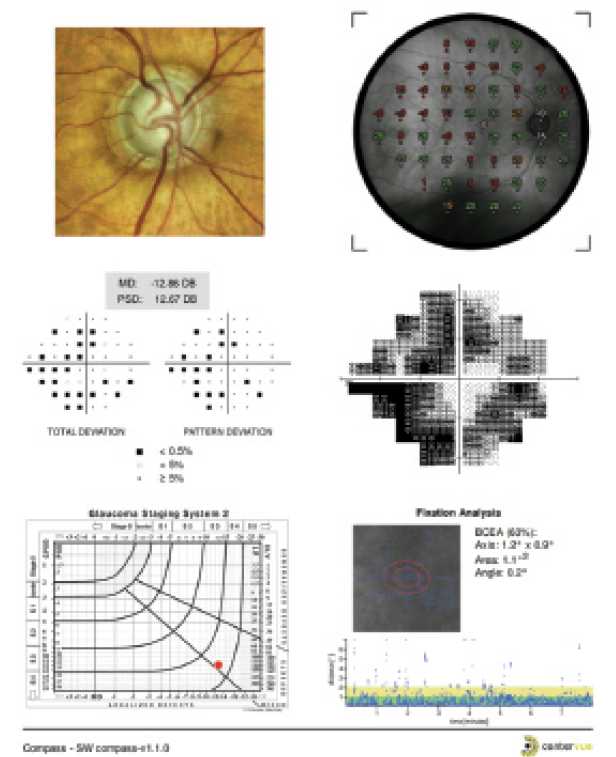 The Next Generation in Perimetry - Glaucoma Today